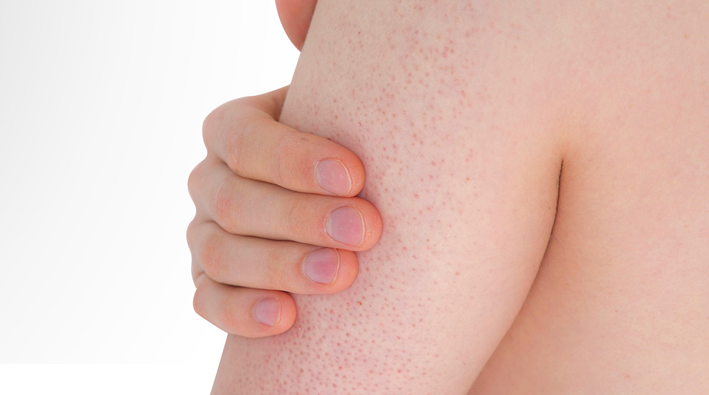 dry bumpy rash