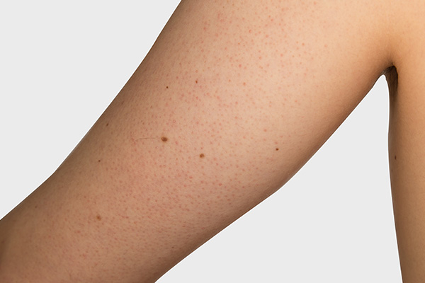 keratosis pilaris on legs and arms